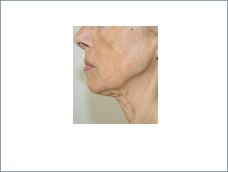 Endolift® - Intermed Global Asia