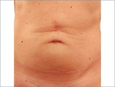 Endolift® - Intermed Global Asia