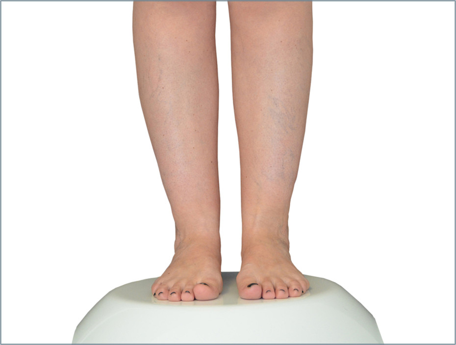 Endolift® - Intermed Global Asia